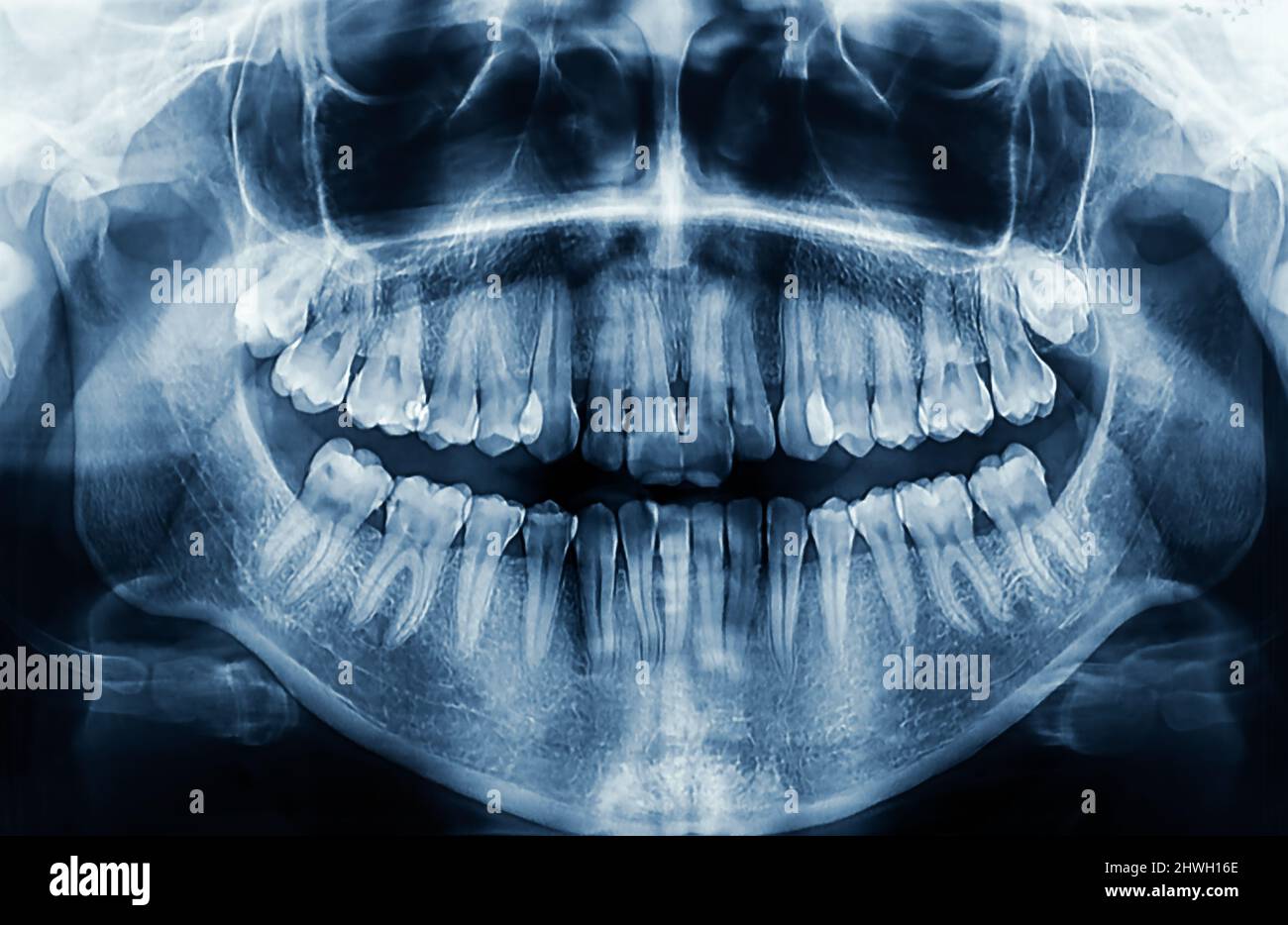 Panoramic dental tooth X-ray of a 26 year old teenage girl Stock Photo ...