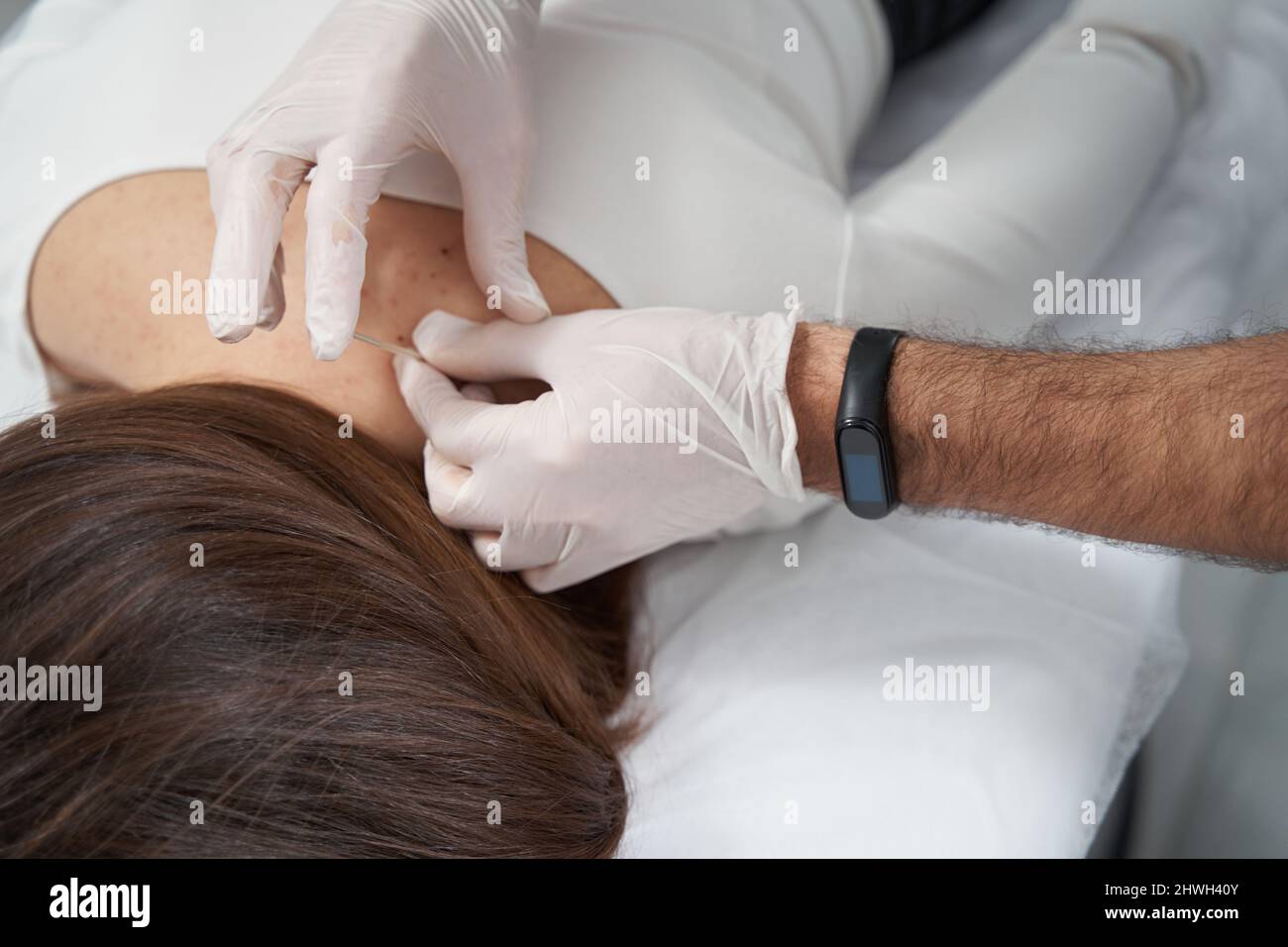 Woman having acupuncture session to relax muscles Stock Photo - Alamy