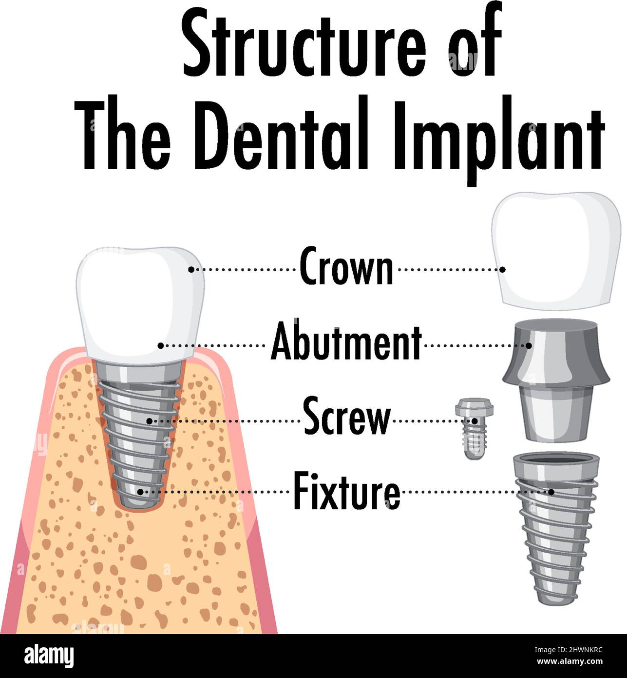 Infographic of human in structure of the dental implant illustration ...