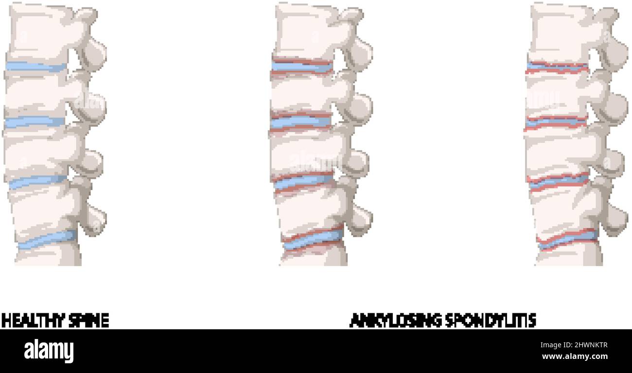 Infographic of healthy spine and ankylosing spondylitis illustration ...
