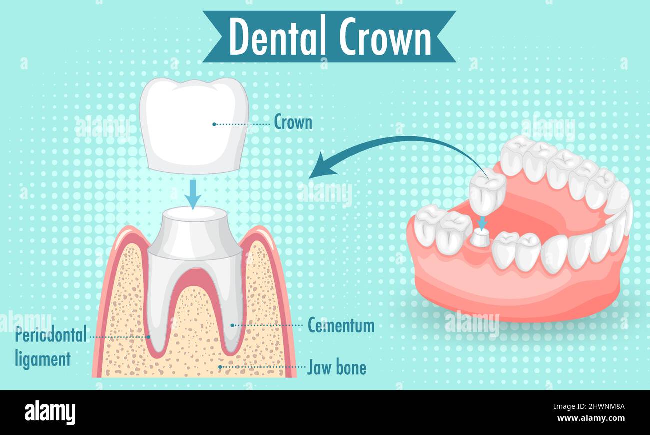 Infographic of human in dental crown illustration Stock Vector Image ...