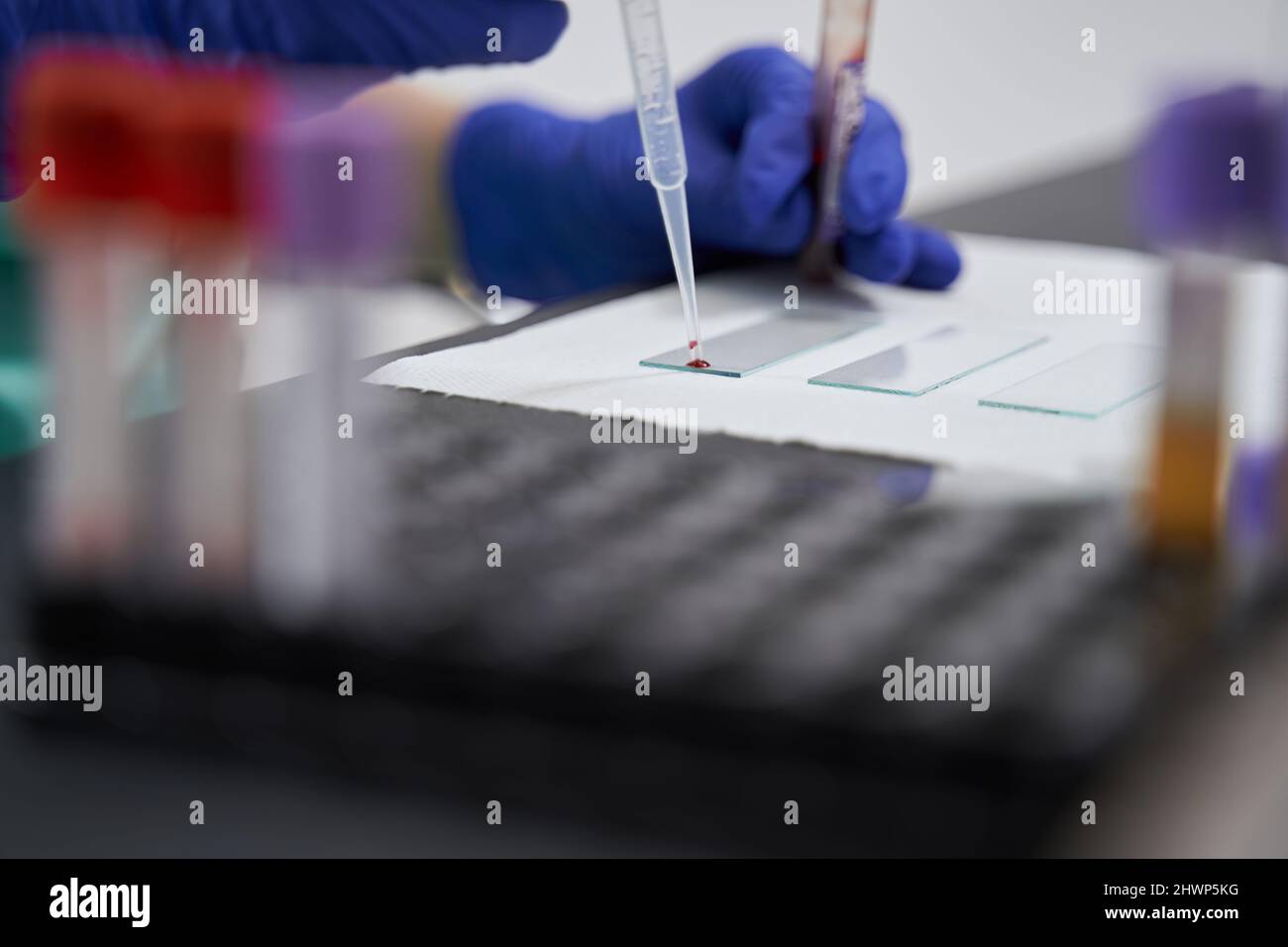 Sedimentation of the blood hi-res stock photography and images - Alamy