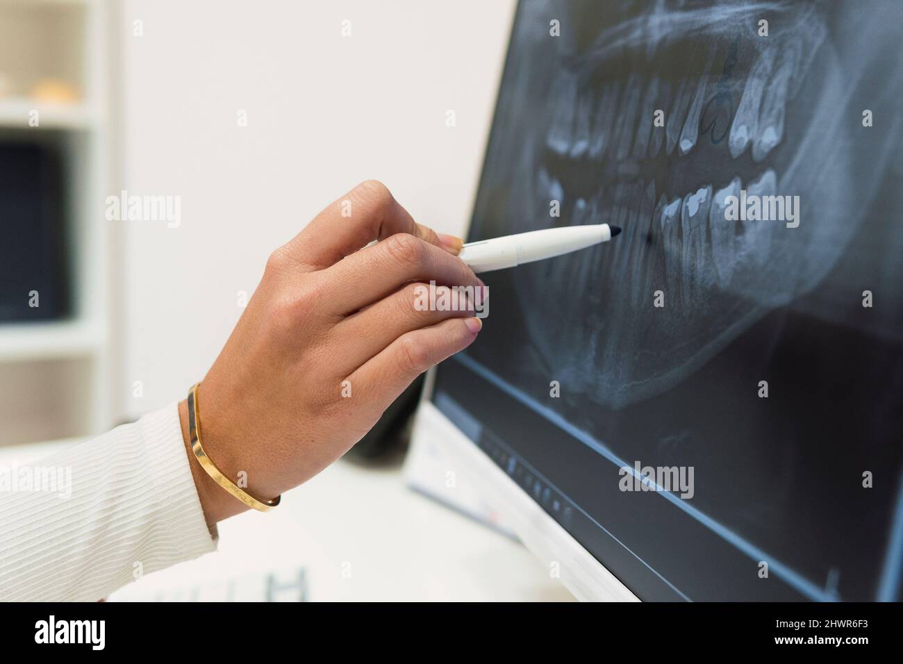 Dentist analyzing teeth X-ray over intraoral scanner screen in clinic ...