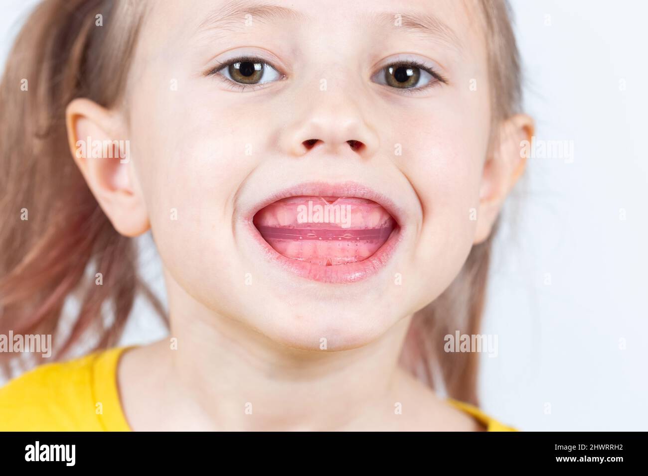 Overbite girl hi-res stock photography and images - Alamy