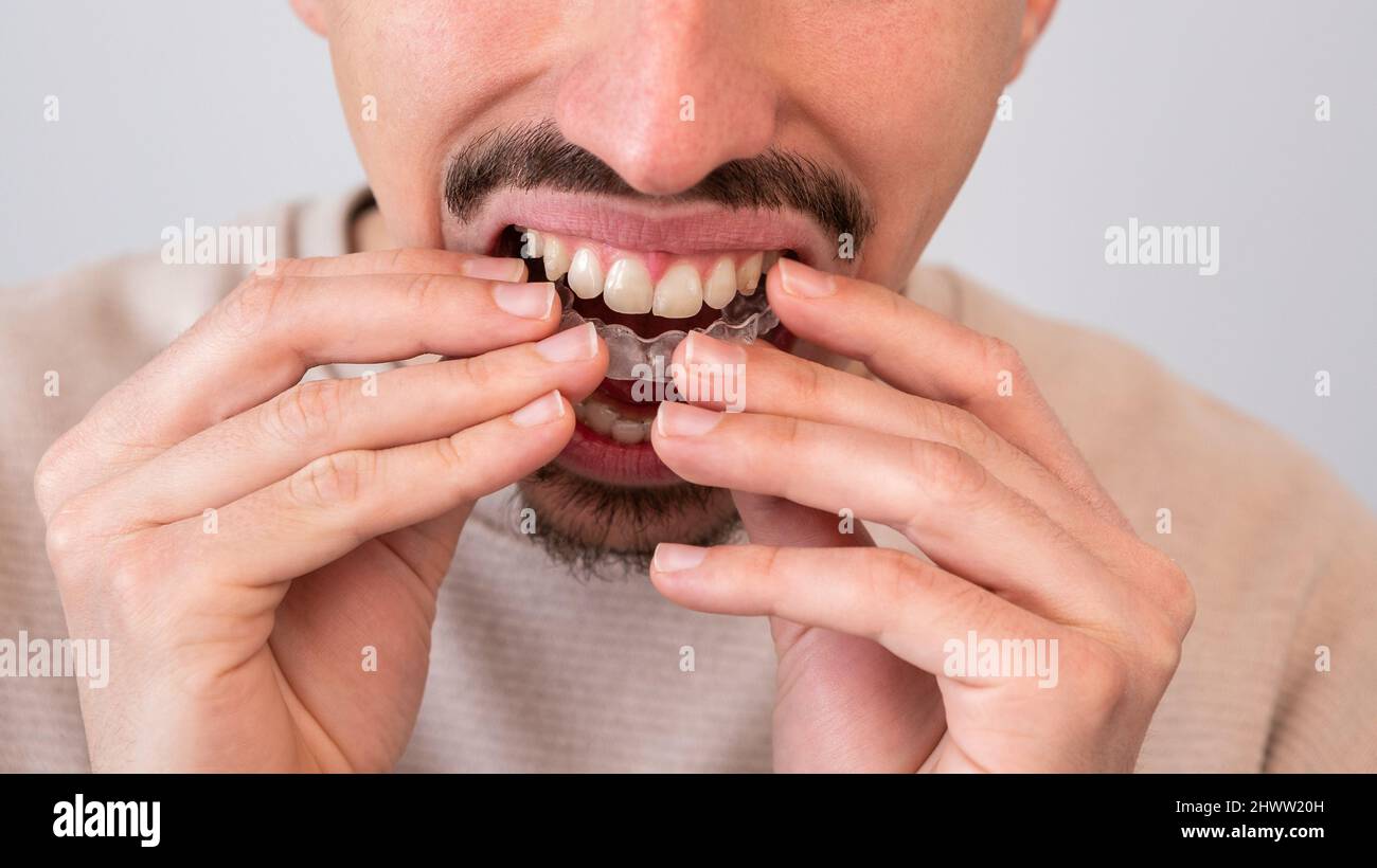 Caucasian young man adjusting and placing an invisible silicone aligner ...