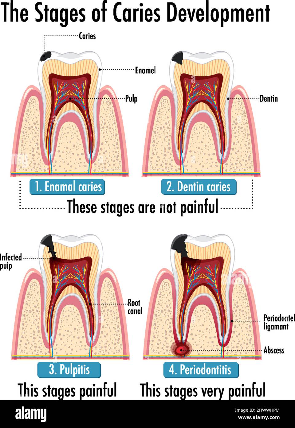 Infographic of human in stages of caries development illustration Stock ...