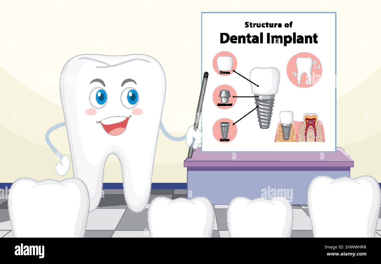 Infographic of human in structure of the dental implant illustration ...