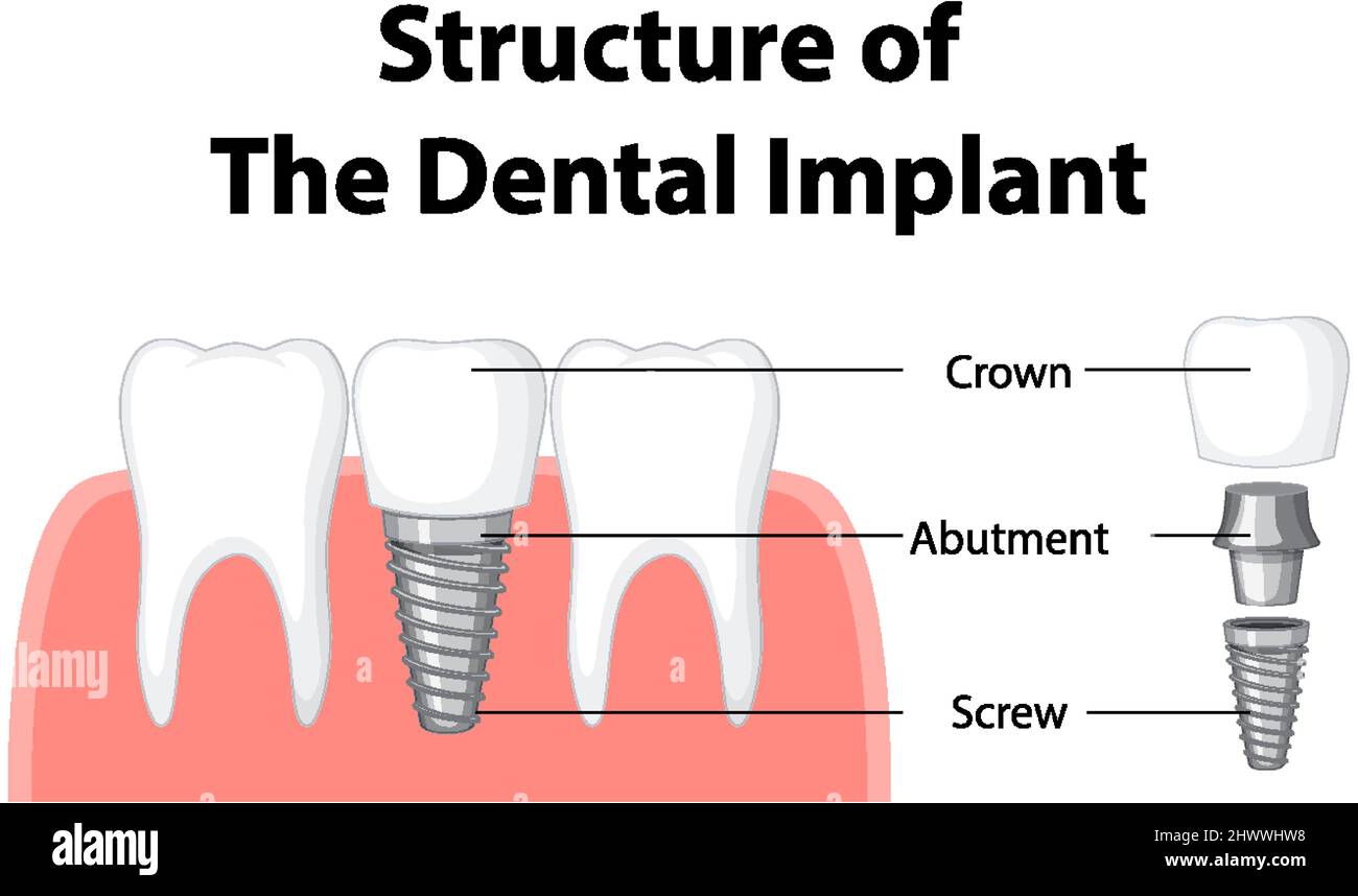 Infographic of human in structure of the dental implant illustration ...