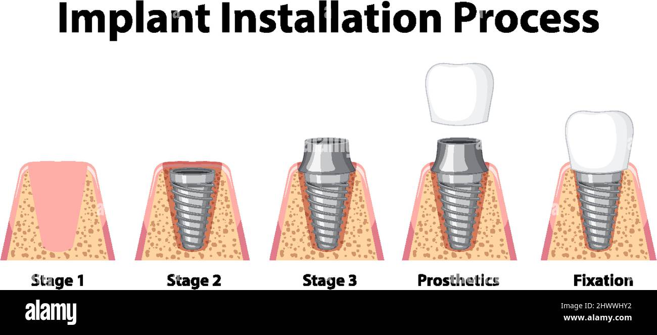 Infographic of human in implant installation process illustration Stock ...