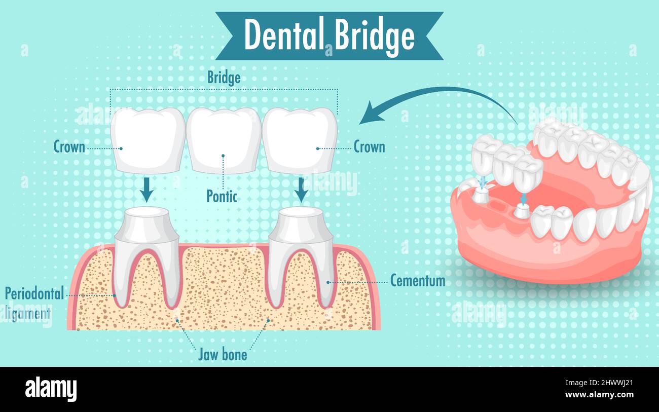 Structure of the dental bridge Stock Vector Images - Alamy
