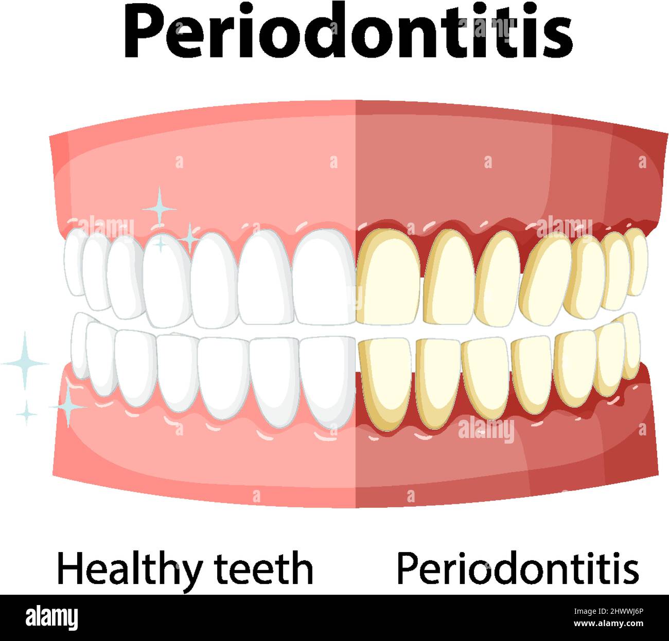 Infographic of human in periodontitis illustration Stock Vector Image ...