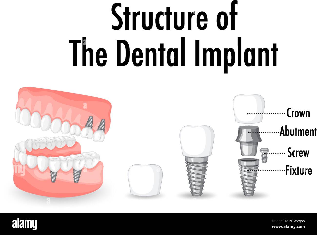 Infographic of human in structure of the dental implant illustration ...