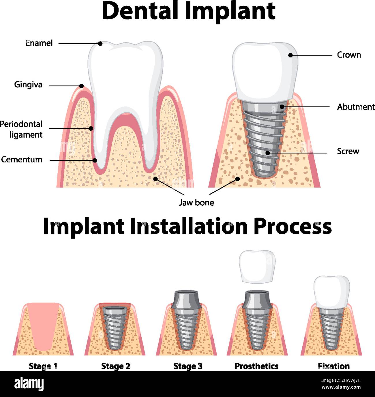 Infographic of human in structure of the dental implant illustration ...