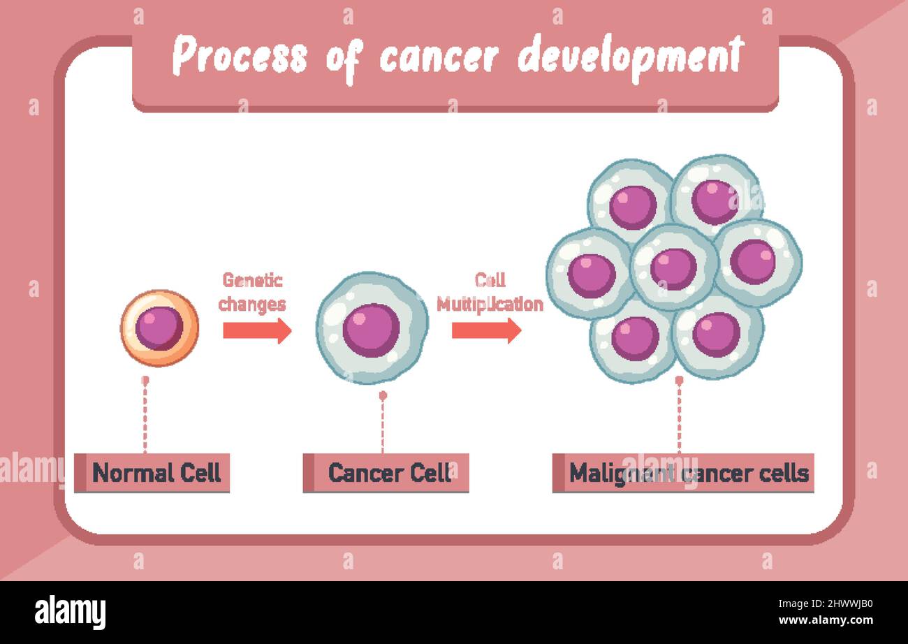 Process of cancer development infographic illustration Stock Vector ...