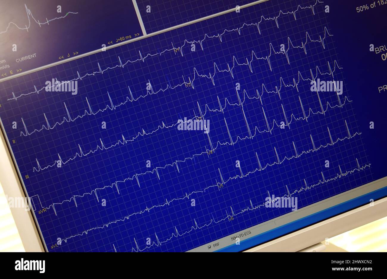 Ecg reading hi-res stock photography and images - Alamy