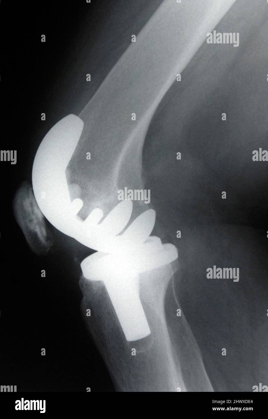 X-Ray of a Female Knee Joint, with Knee Cap Stock Photo - Alamy