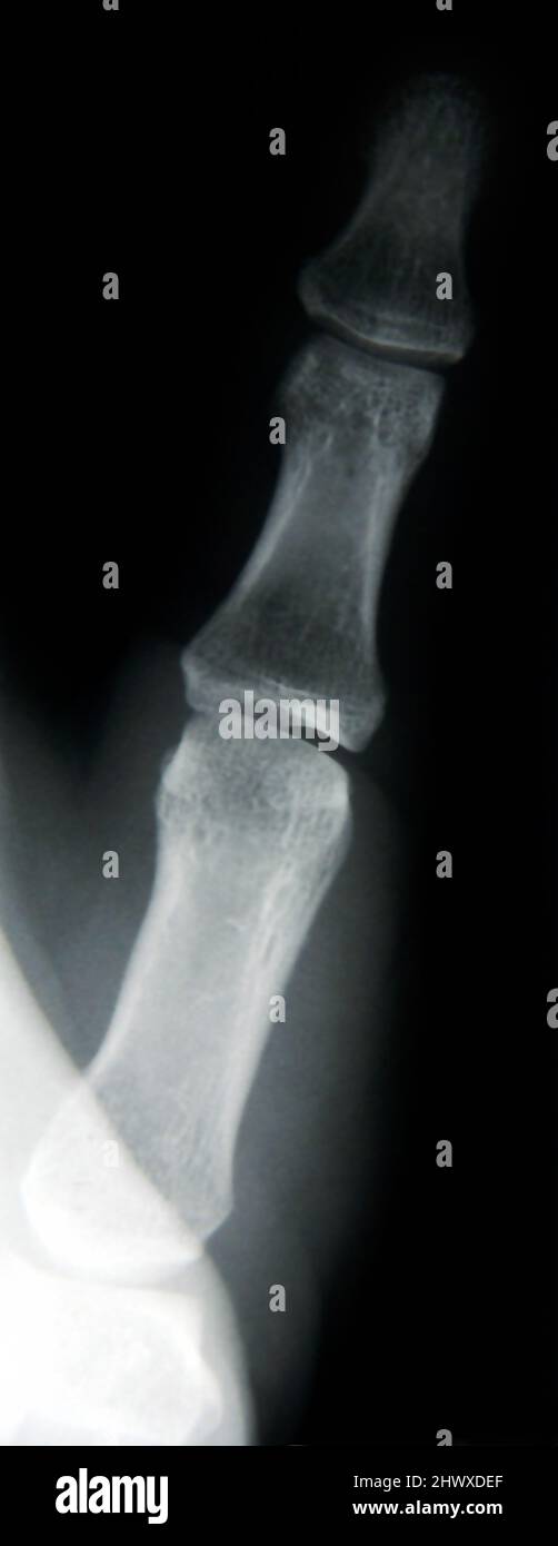 X- Ray of a Female Finger Stock Photo - Alamy