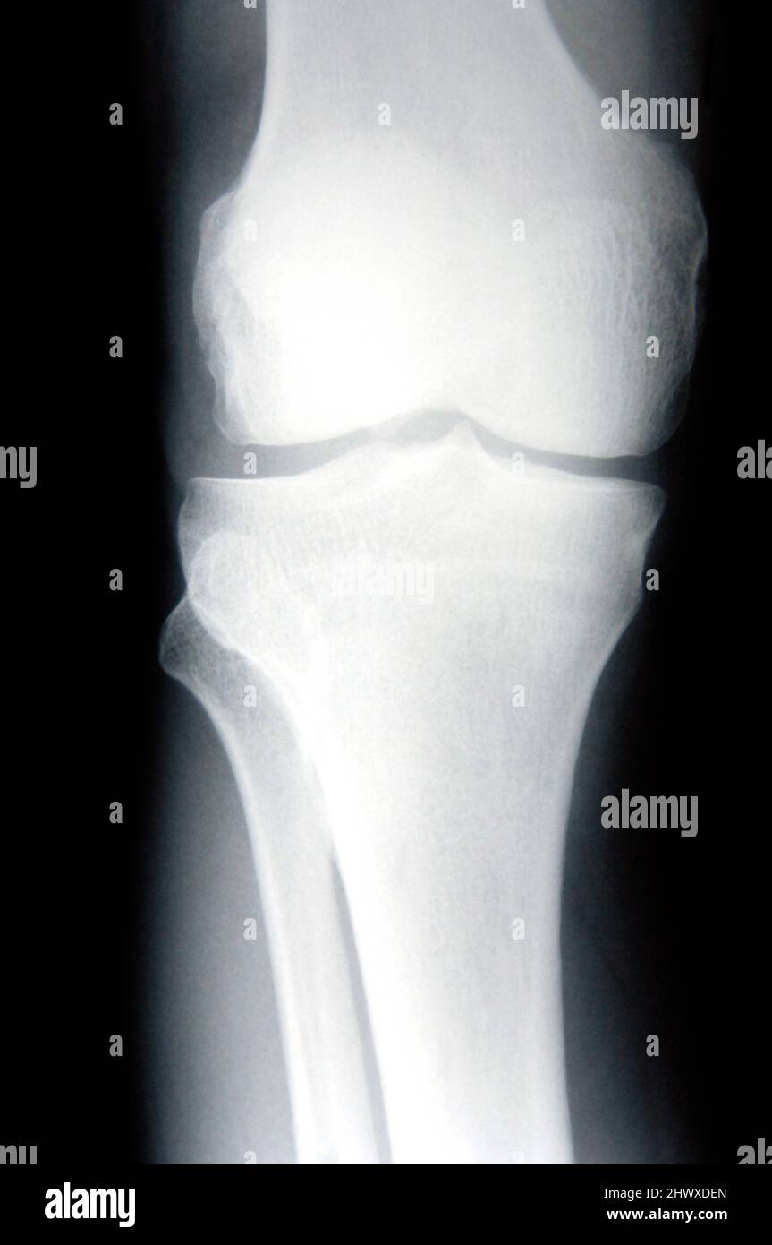 X-Ray of a Female Knee Joint, with Knee Cap Stock Photo - Alamy