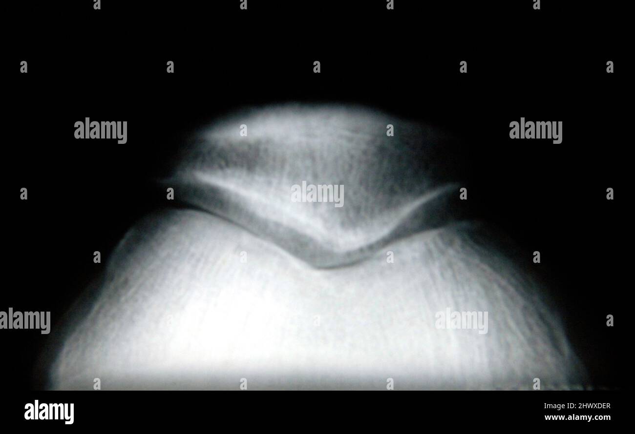 X-Ray of a Female Knee Joint, with Knee Cap Stock Photo - Alamy