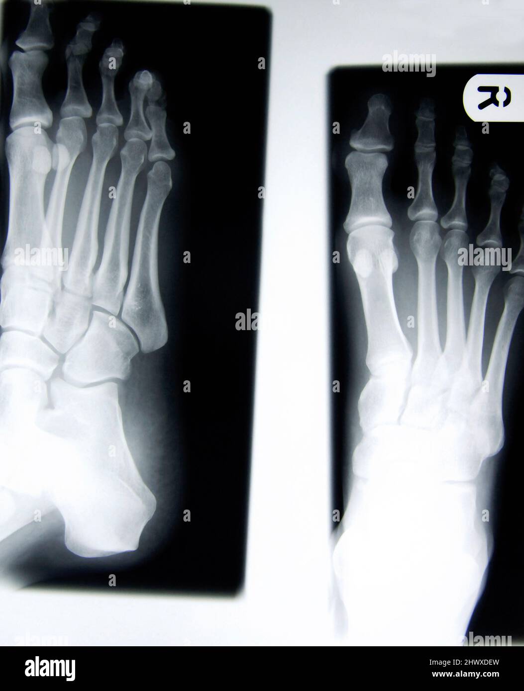 X-ray of a Female Foot Stock Photo - Alamy