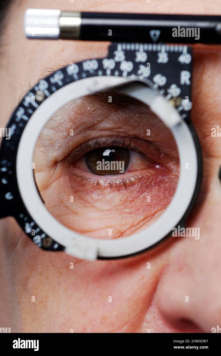 A trial frame is used to find the best lens for a patient with a ...