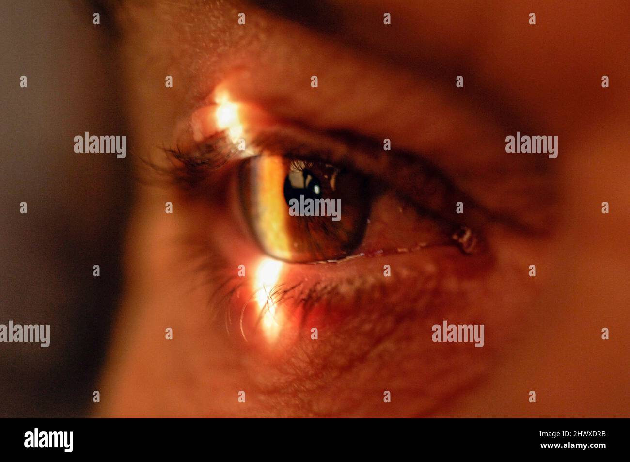 A slit lamp illuminates a patient’s eye during an eye exam. The ...