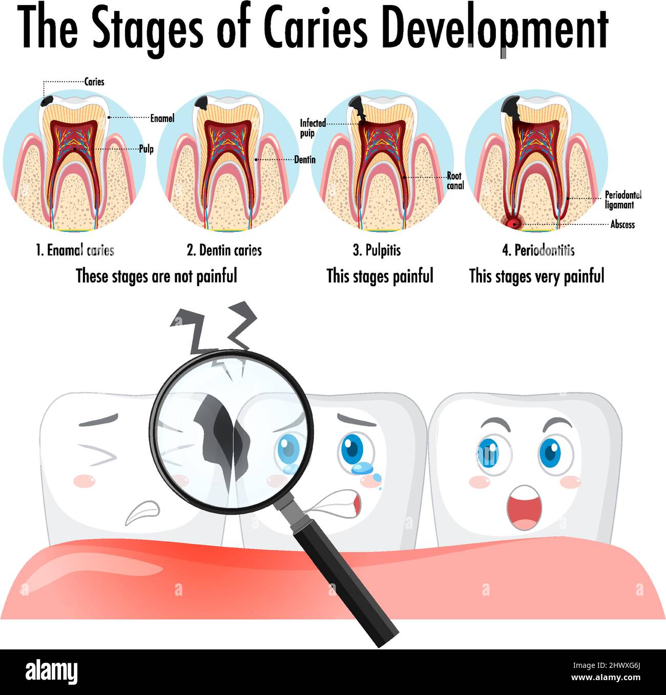 Infographic of human in stages of caries development illustration Stock ...