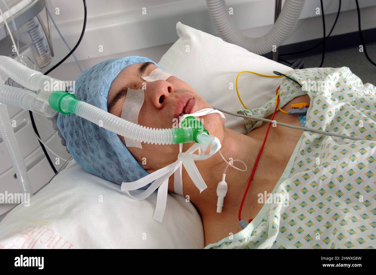 Close up of an anaesthetised male patient with tubes in the mouth ...