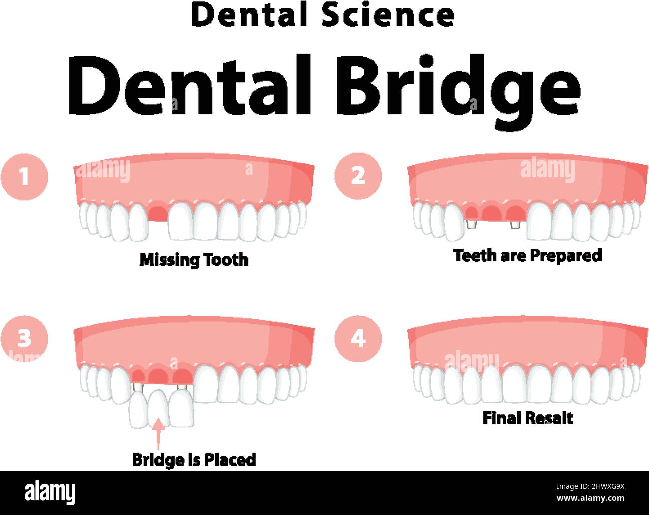 Infographic of human in dental bridge on white background illustration ...