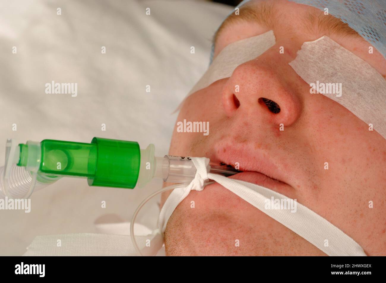 Close up of an anaesthetised patient.(MODEL RELEASED Stock Photo - Alamy