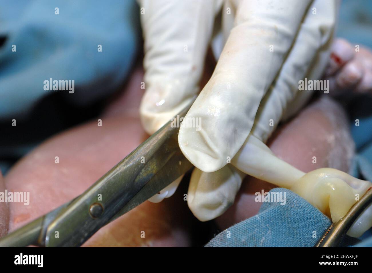 The umbilical cord is cut Stock Photo - Alamy