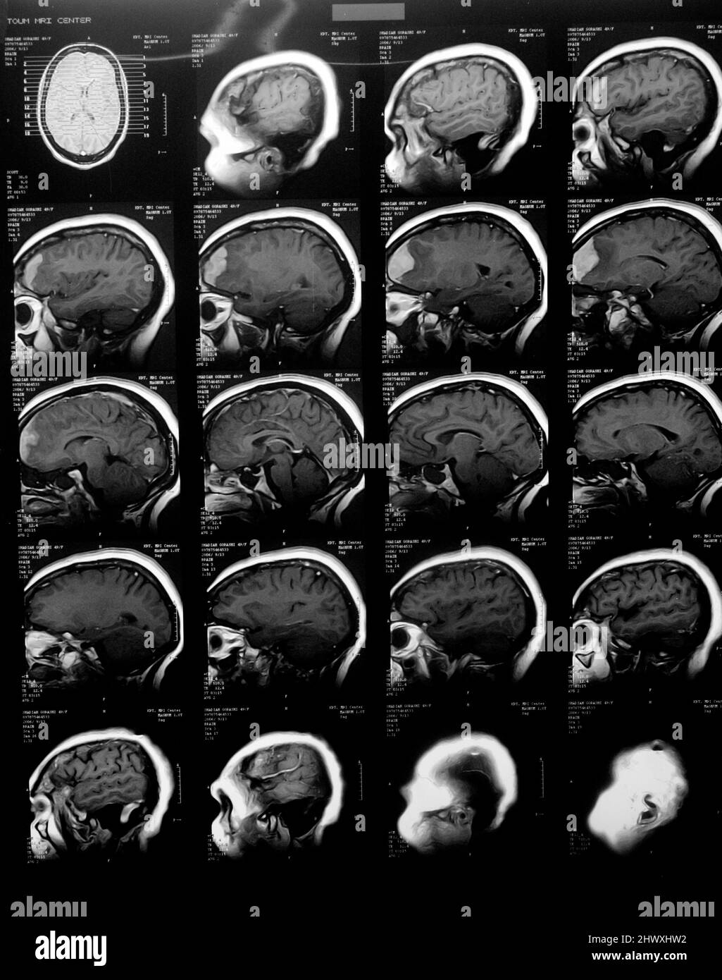 MRI scan of a female's head. The patient is suffereing from bilateral ...