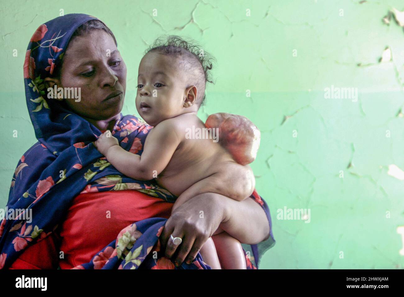 A mother holds her 5 month old baby, born with meningomyelocele, this ...