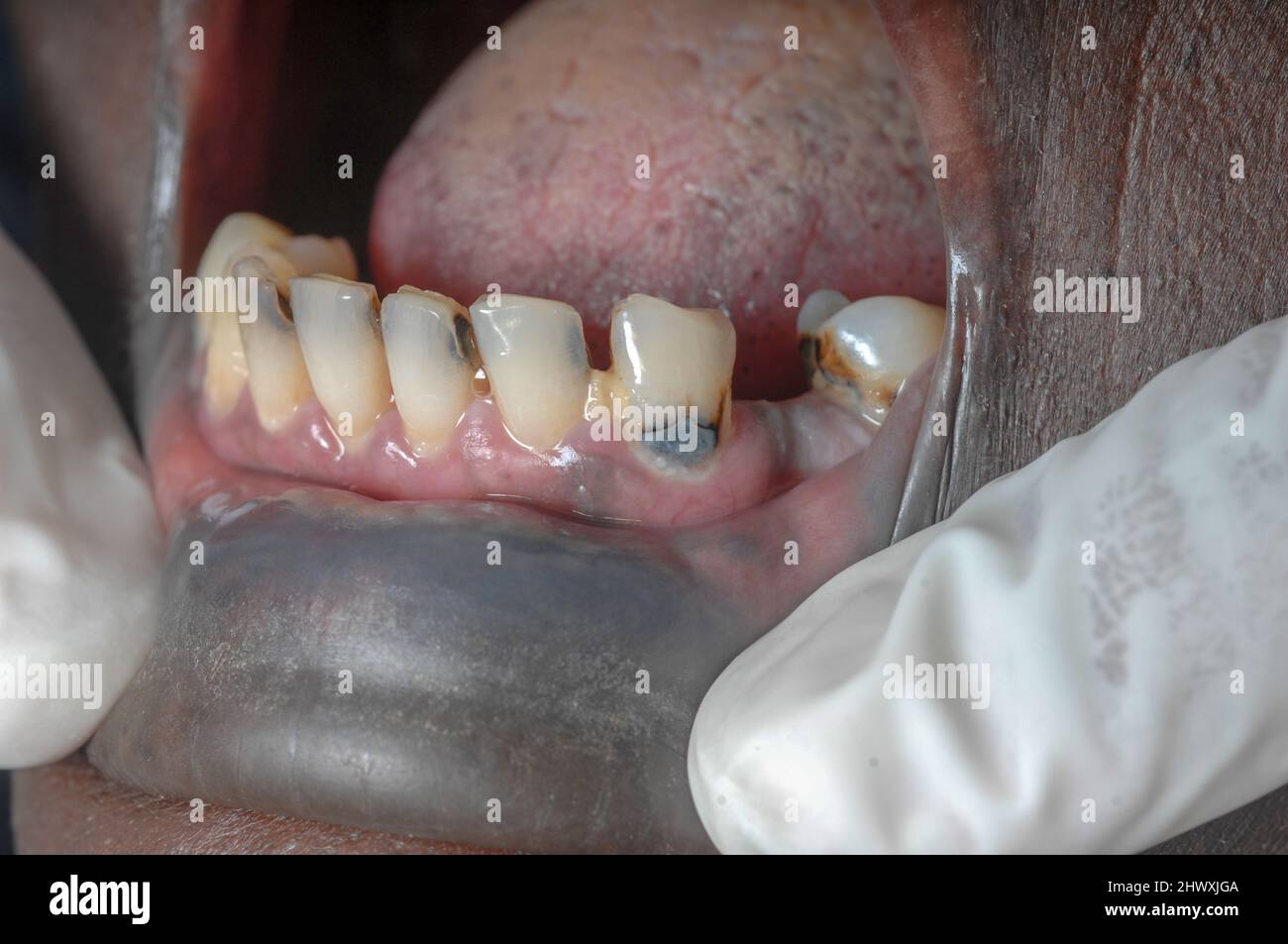 Chronic Periodontitis. The most common type of gum disease ...