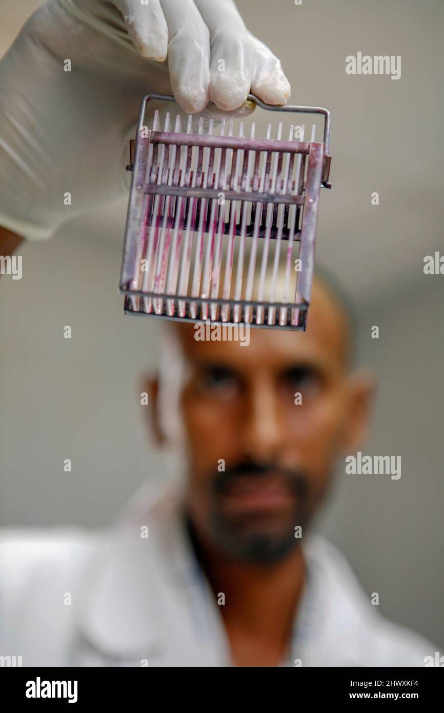 A pathologist holding up a dyed set of sample slides (MODEL RELEASED ...