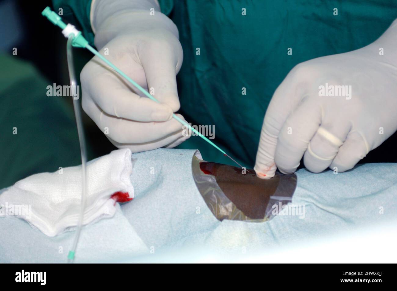 Introducer sheath hi-res stock photography and images - Alamy