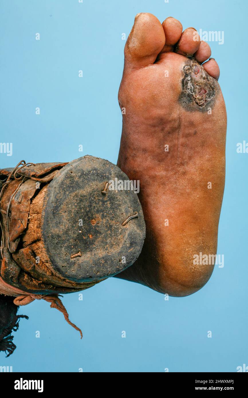 Soft tissue granuloma hi-res stock photography and images - Alamy