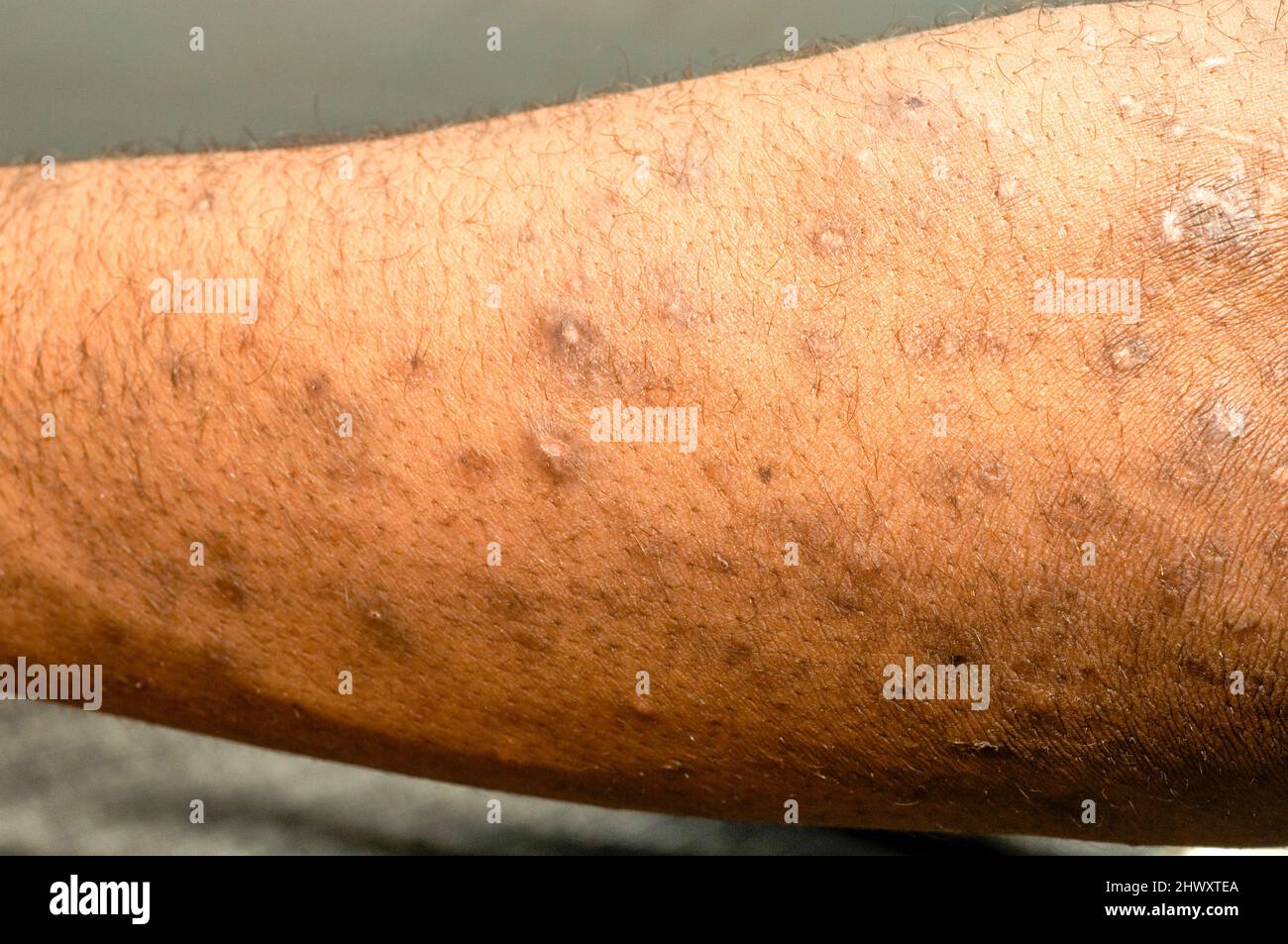Mild Psoriasis Arm