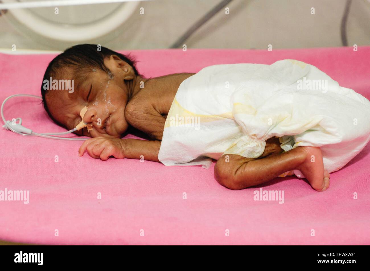 Premature baby in an incubator in the neonatal unit of a hospital ...