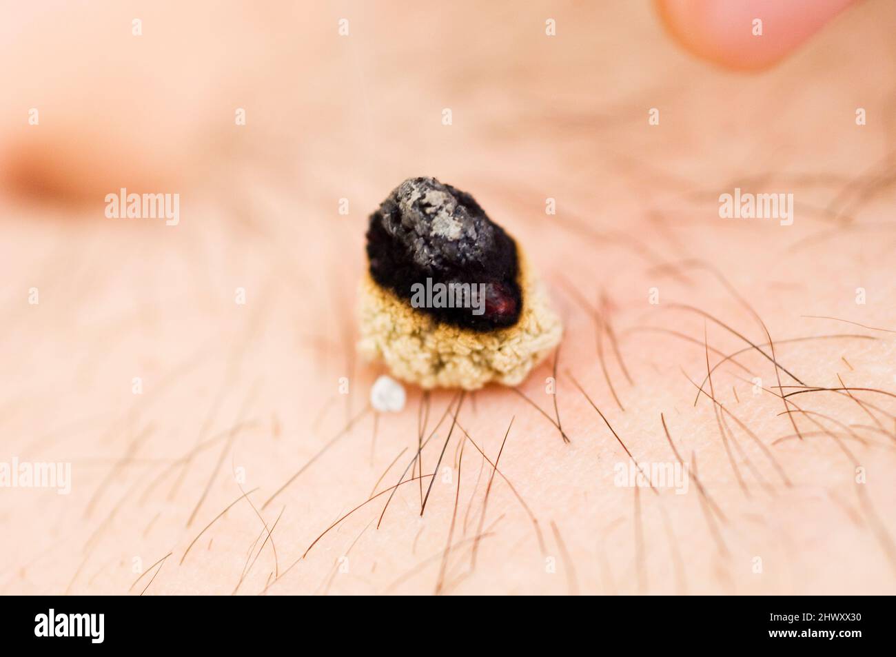 Medicine technique hi-res stock photography and images - Alamy