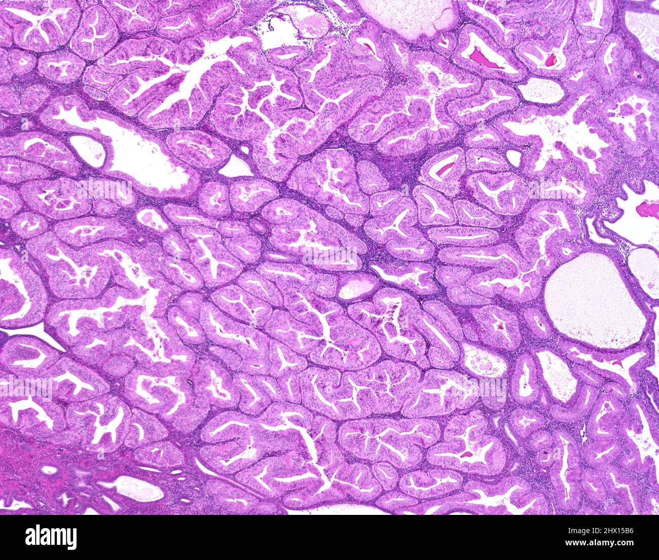 Endometrioid carcinoma, grade 1, light micrograph Stock Photo - Alamy
