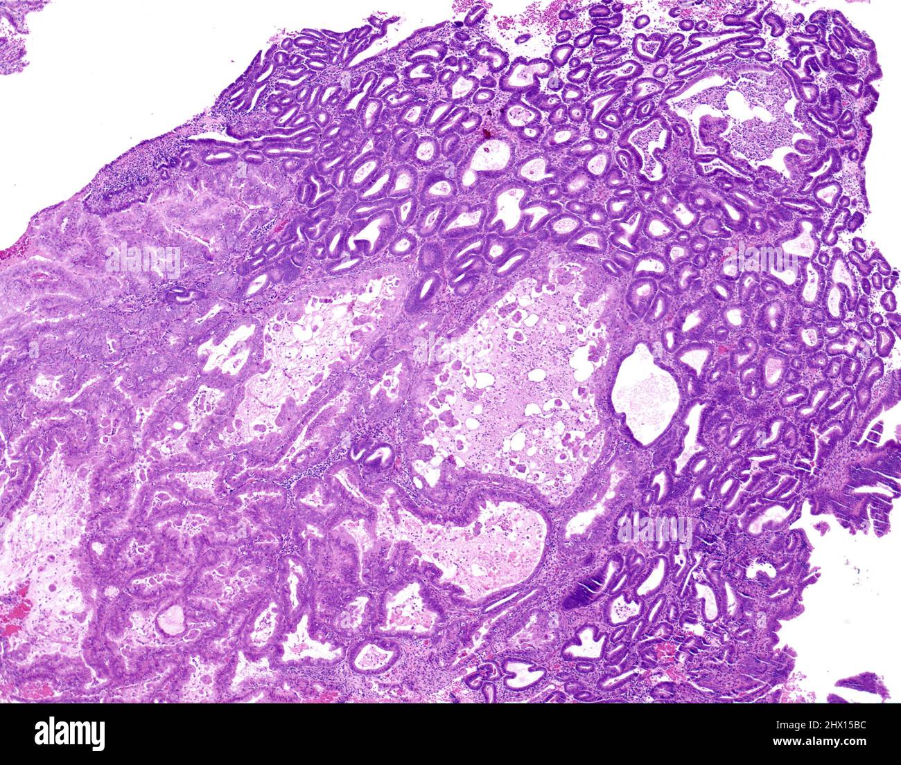 Atypical endometrial hyperplasia, light micrograph Stock Photo - Alamy