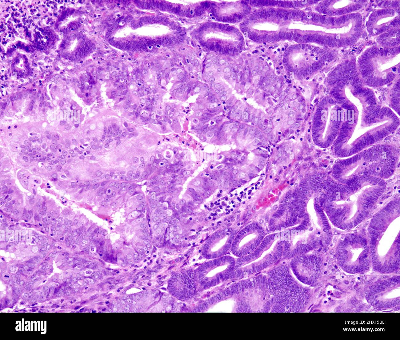 Atypical endometrial hyperplasia, light micrograph Stock Photo - Alamy