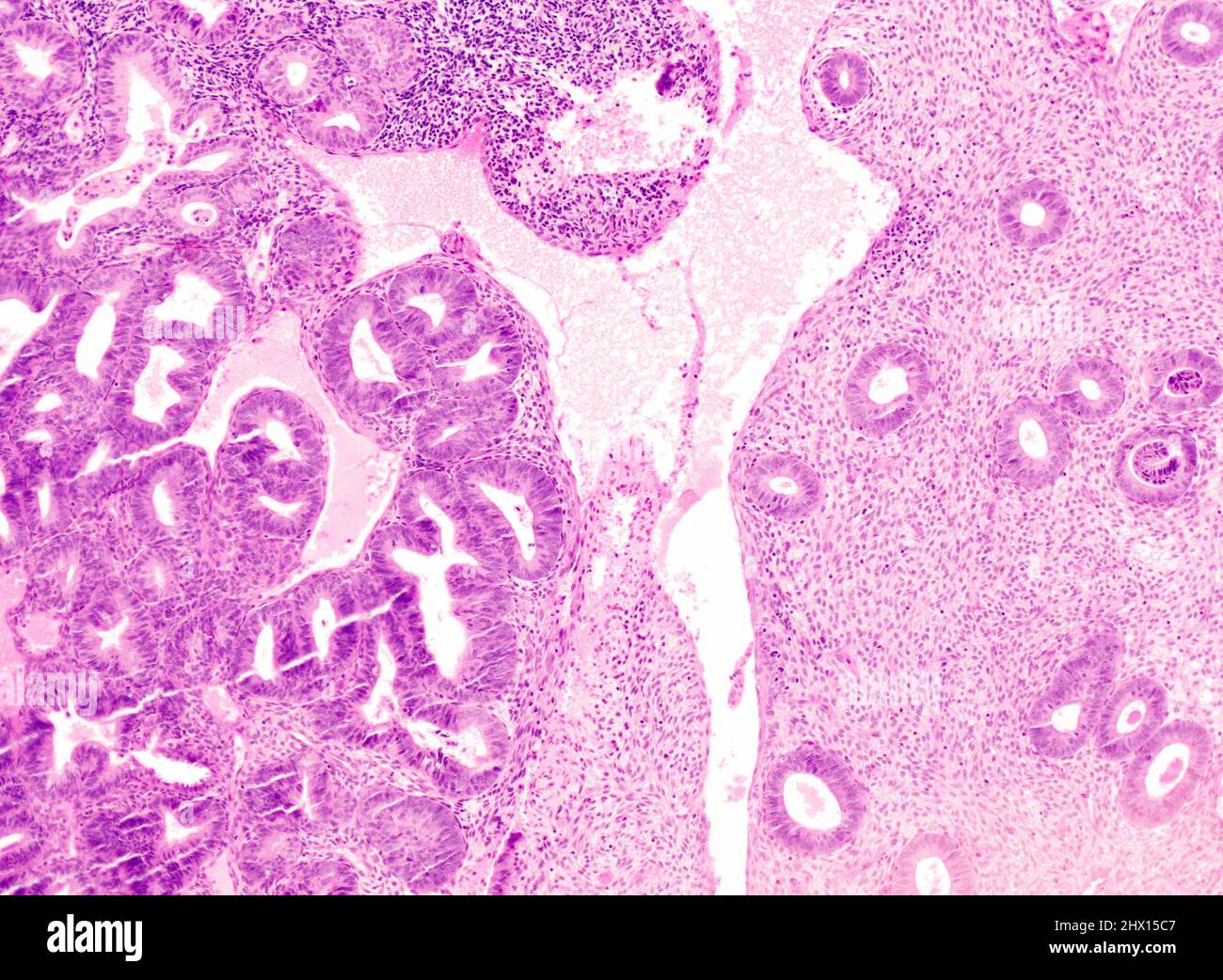 Atypical endometrial hyperplasia, light micrograph Stock Photo - Alamy