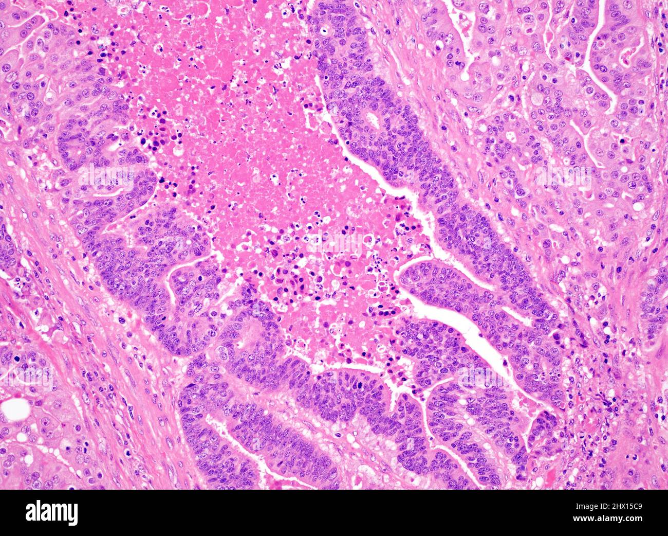 Endometrioid carcinoma with necrosis, light micrograph Stock Photo - Alamy