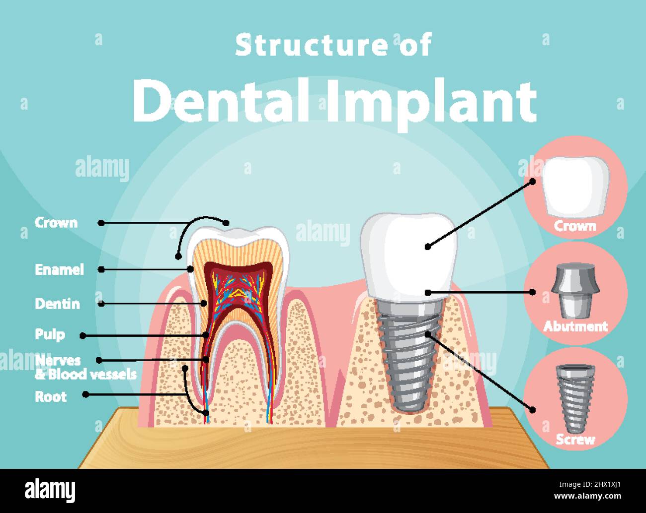 Infographic of human in structure of the dental implant illustration ...