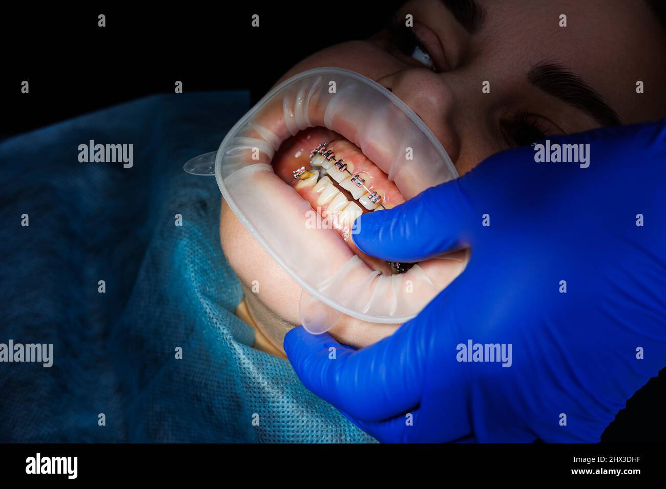 Extender for teeth. Teeth of a woman with braces at a dentist ...