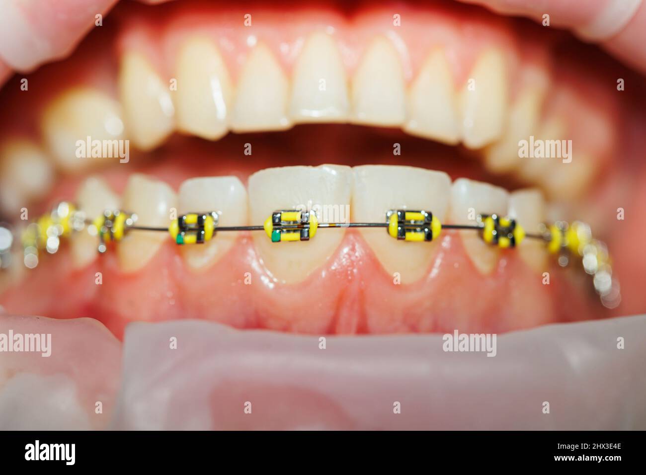 Extender for teeth. Teeth of a woman with braces at a dentist ...