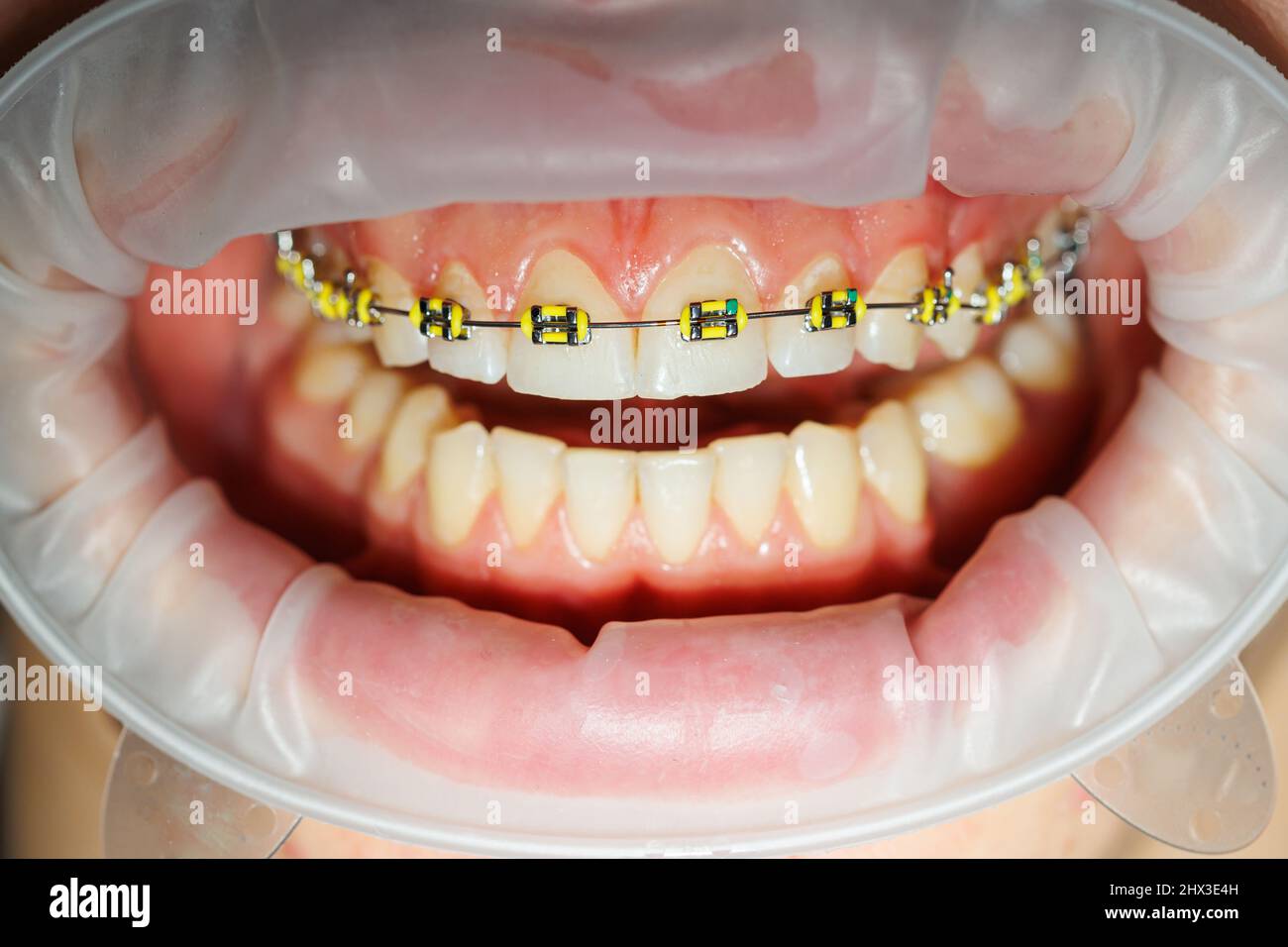 Extender for teeth. Teeth of a woman with braces at a dentist ...