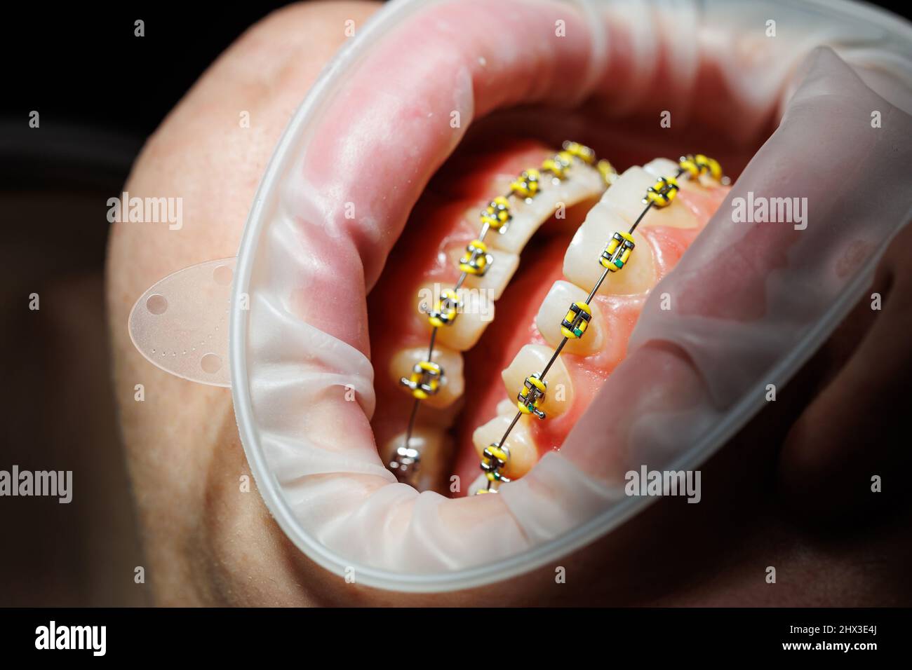 Extender for teeth. Teeth of a woman with braces at a dentist ...